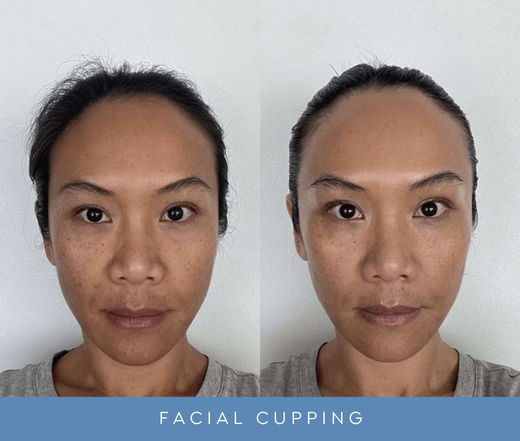 Facial Cupping – Sérénité by Sakina Di Pace